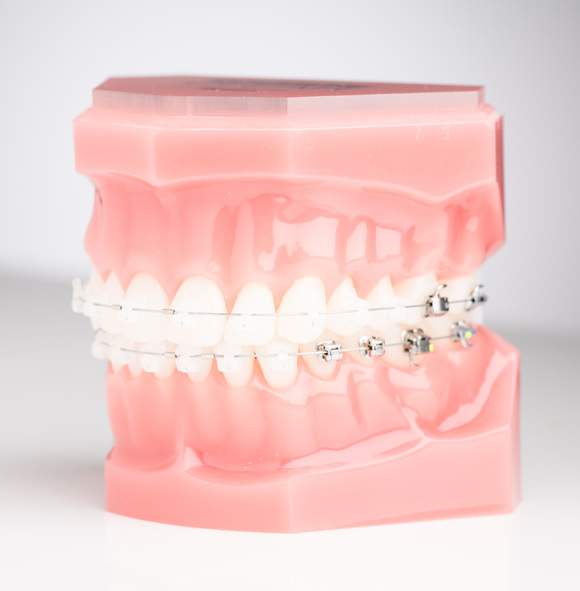Your Comprehensive Guide to Braces: Achieve a Perfect Smile | American ...